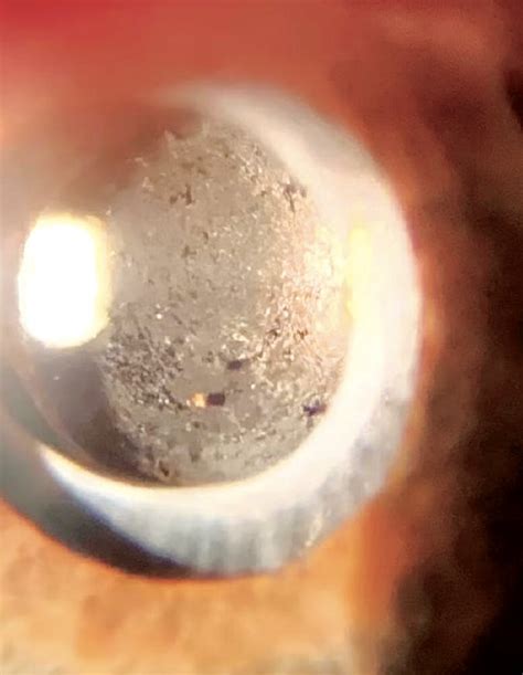 Iol Opacification Modern Optometry