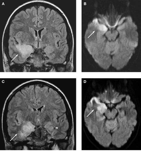 Encephalitis Mri