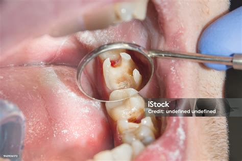 치아 확대해 Endodontic 치료입니다 치아와 그들의 작성의 뿌리의 청소 치과 클리닉에서 현대 기술의 개념 건강관리와 의술에 대한 스톡 사진 및 기타 이미지 Istock