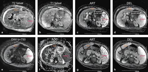 Parenchymal Liver Disease