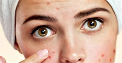 Angie S Lifestyle Tips Prevent Pimples By Following These Simple Tips