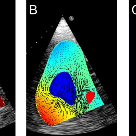 Example Of Lv Intraventricular Flow Analysis Using Echo Particle