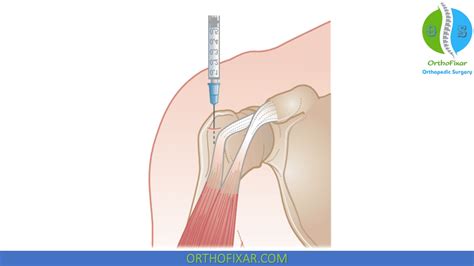 Biceps Tendon Injection Easily Step By Step Orthofixar
