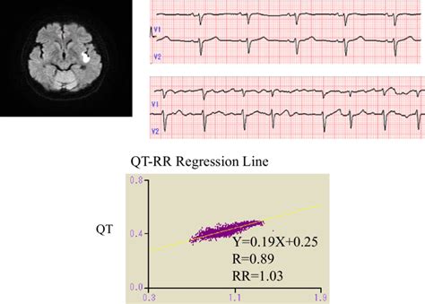 Figure1representative Qt Rr Relationship In A 65 Year Old Woman With