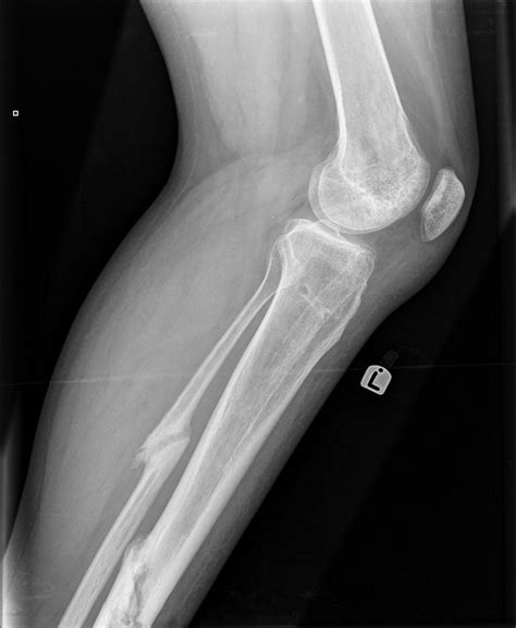 Hijacking And Broken Tibia And Fibula R Xrays