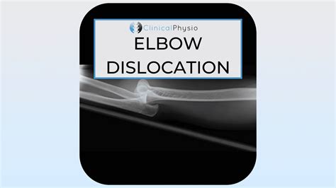 Elbow Dislocations Clinical Physio Membership