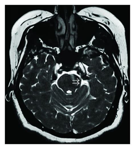 Axial 3d Fiesta Mr Image Shows Nodular Lesions Arrow With Dark Signal Download Scientific