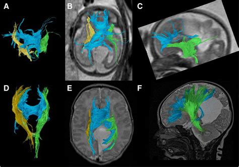 Fetal And Postnatal Corpus Callosum And Corticospinal Tract