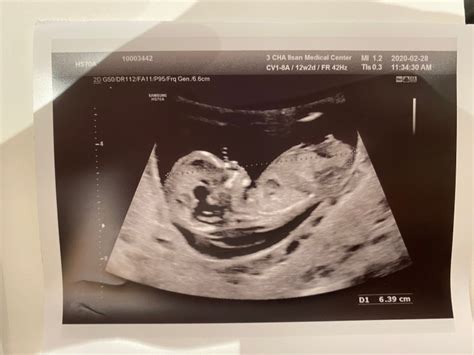 [후기] 일산차병원 산부인과 임신12주차 첫진료 받았어요 1차기형아검사 초음파사진 전원 네이버 블로그