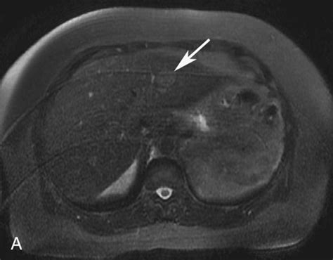 Pulsation And Other Artifacts Radiology Key