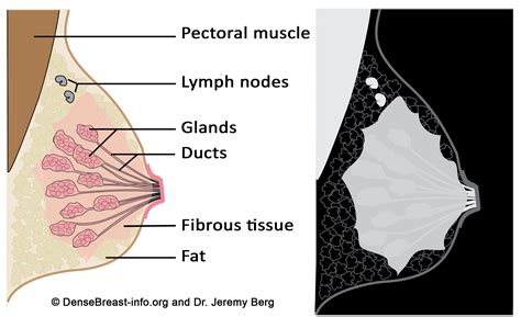 √ダウンロード Breast Parenchyma Is Heterogeneously Dense 750361 Breast