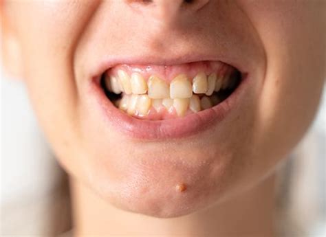 What Are Aligner Chewies Used For The Key Benefits