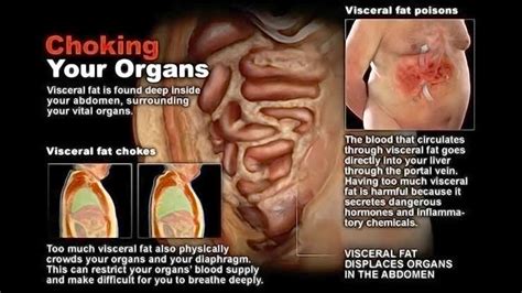 Hati Buat Yg Perutnya Seperti Pada Gambar Soalnya Lebih Berbahaya Dibanding Obesitas Biasa