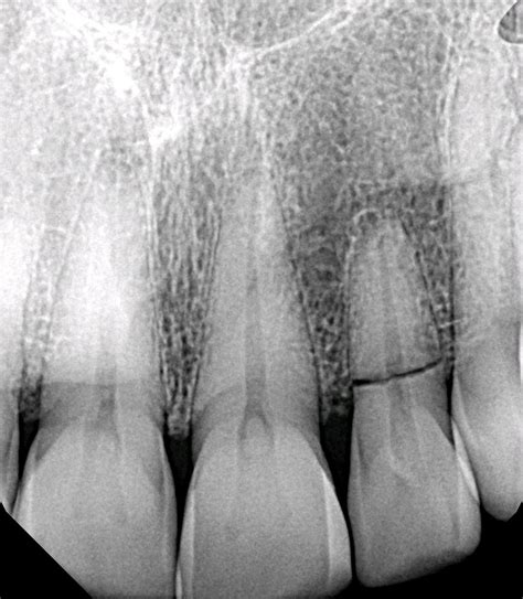 Horizontal Root Fracture R Askdentists