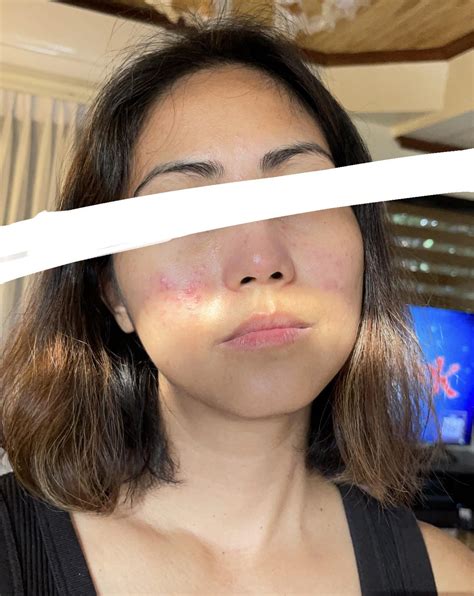 Rosacea Type 2 Whats Your Skin Regimen Help Pls Rrosacea