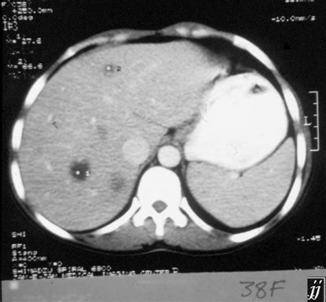 Abdomen Stomach Cancer Metastasis 38f 2 Radioogle