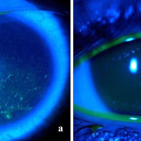 Anterior Segment Photograph Of The Right Eye Showing Punctate Download Scientific Diagram