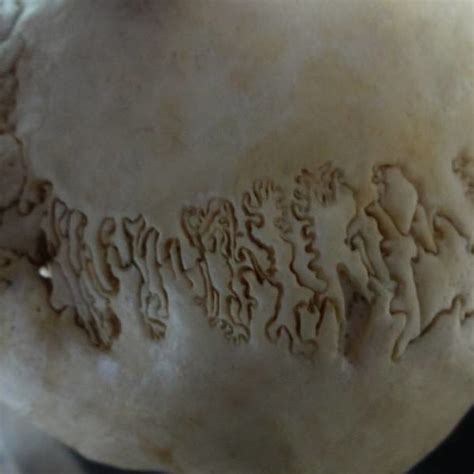 Pdf Sutural Bones Associated With Lambdoid Suture Of Human Skull Presence Variations And