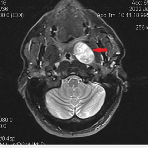Mri Imaging T1 Transverse Showing The Parapharyngeal Space Mass With