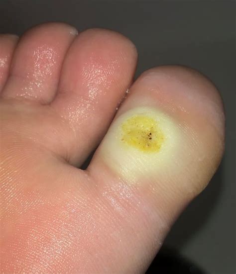 Plantar Wart Treatment Progression Rwarts