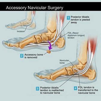 Type 2 Os Navicular Bone