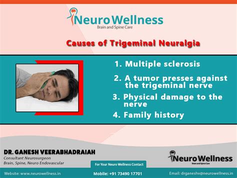Trigeminal Neuralgia Trigger Points
