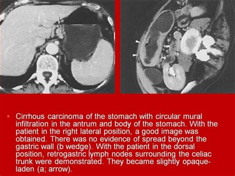 Whole Body Computed Tomography Git Ppt