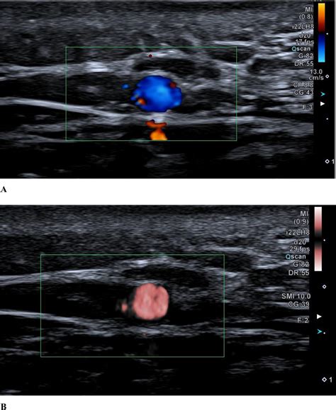 Temporal Artery Ultrasound To Diagnose Giant Cell Arteritis A