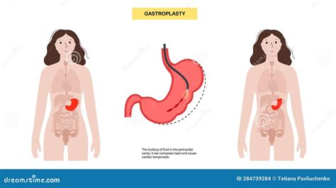 Endoscopic Sleeve Gastroplasty Vector Illustration 285069338
