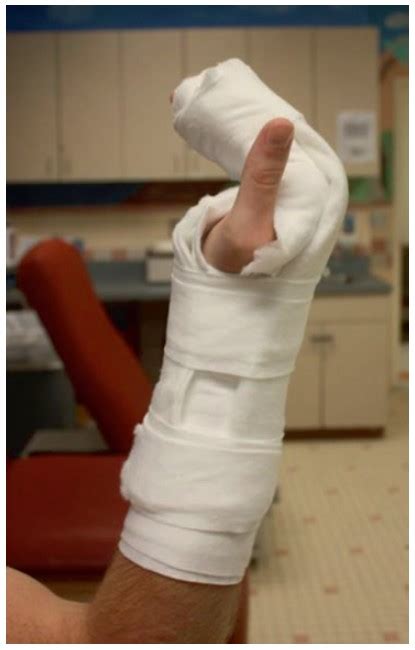 Intrinsic Plus Splint Wikism Sports Medicine Wiki