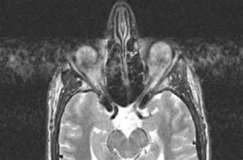 Phase Encoding Direction Questions And Answers In Mri