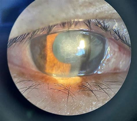 After 5 Days Of Treatment A Slit Lamp Microscope Was Used To Check The