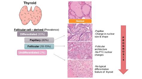 Stage 4 Thyroid Cancer Treatment In Germany Advanced Options For