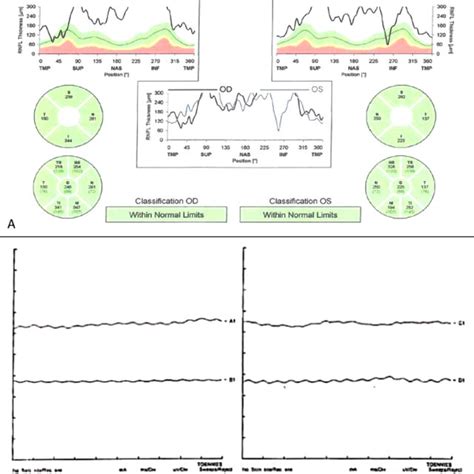 Brain Ct Scan Hypodensity And Loss Of Gray White Matter Download Scientific Diagram