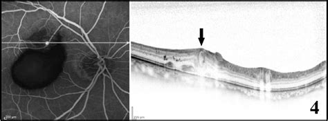 Vision Loss From Ruptured Retinal Artery Macroaneurysm The National Medical Journal Of India