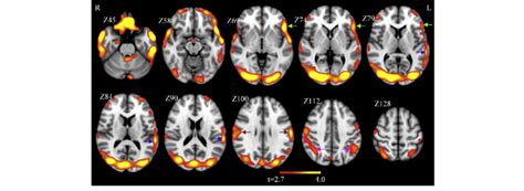 Voxel Wise Significant Meg Responses Evoked By Object Naming Task Download Scientific Diagram