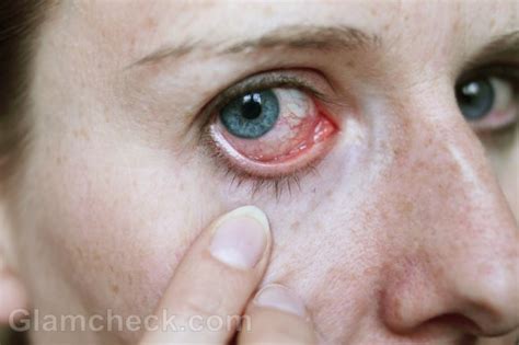 Types Of Eye Infections Symptoms Causes Treatments