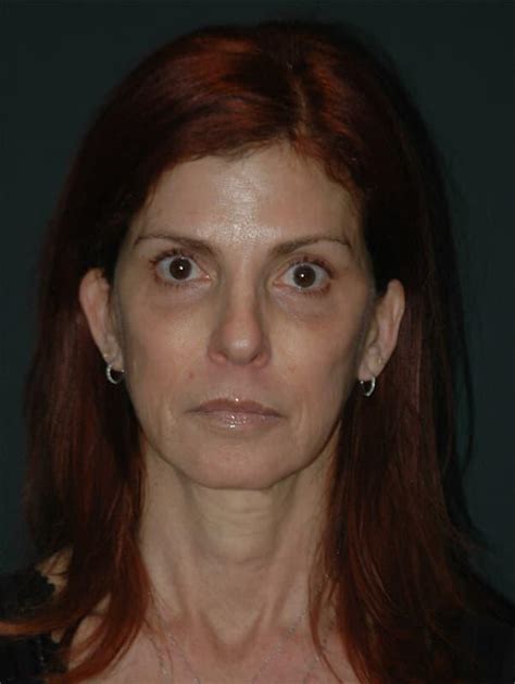 Blepharoplasty Before And After Patient 19