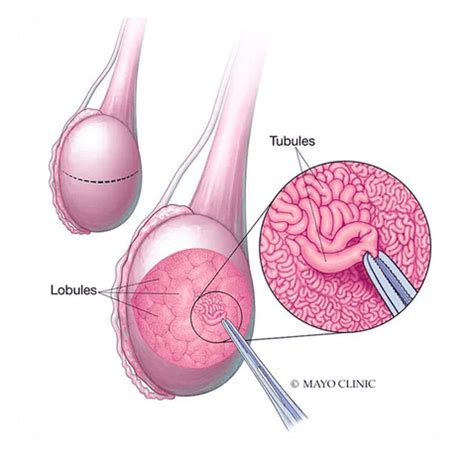 Microsurgical Sperm Aspiration Male Infertility Treatment Centre Trivandrum