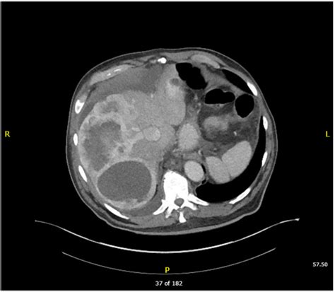 Computed Tomography Scan Revealing Extensive Hepatic Metastases Download Scientific Diagram