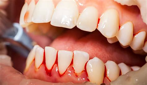The Silent Threat How Gum Diseases Lead To Tooth Loss