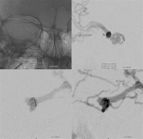 Cavernous Sinus Dural Fistula Occluded Inferior Petrosal Sinus Access
