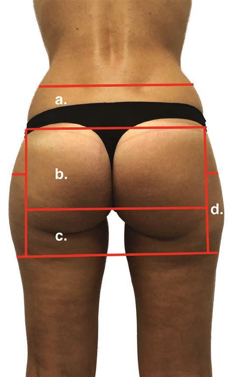Buttocks Have Been Divided Into Four Areas Which Represent The Download Scientific Diagram