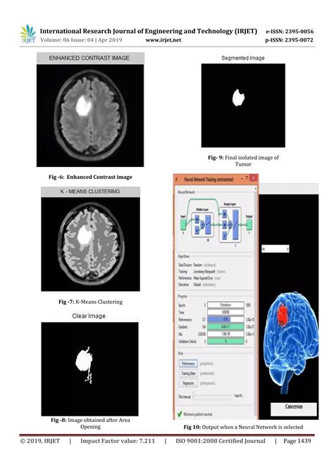 Irjet Mri Image Processing Operations For Brain Tumor Detection Pdf