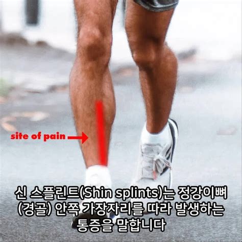 러너들의 고질병 신 스플린트shin Splints Periostitis 네이버 블로그