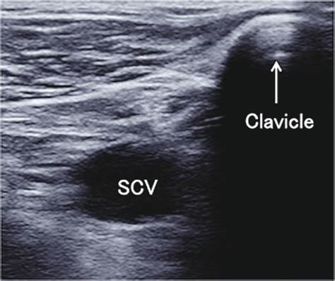 Figure 2 From Collapsibility Of The Right Internal Jugular Vein Predicts Responsiveness To Fluid