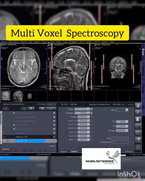 Sasan Tizro On Linkedin Mrspectroscopy Magneticresounanceimaging
