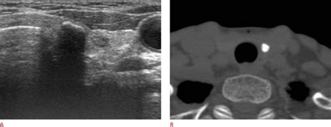 Ct Features Of Thyroid Nodules With Isolated Macrocalcifications