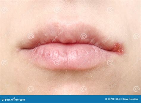 Symptom Of Herpes Zoster Shingles Royalty Free Stock Image