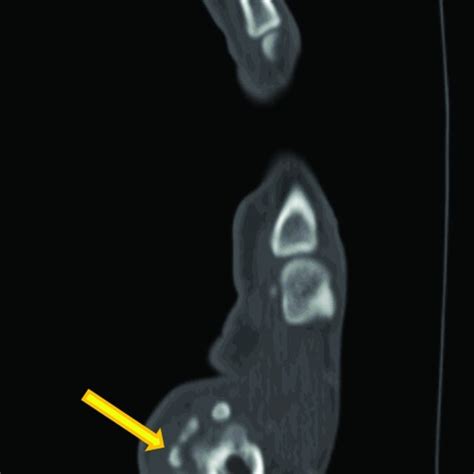 Computed Tomography Foci Of Mineralization Arrow Are Again Seen Download Scientific Diagram